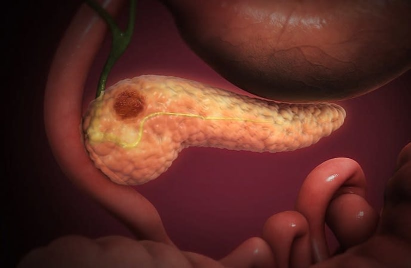 Israeli scientists find way to treat deadly pancreatic cancer in 14 ...